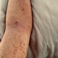 How cryotherapy has changed the lives of Topical steroid withdrawal ...